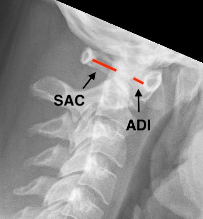 Atlanto-axial instability | The Bone School